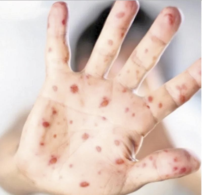 ¡SUMAN YA 800 CASOS DE SARAMPIÓN EN EU!